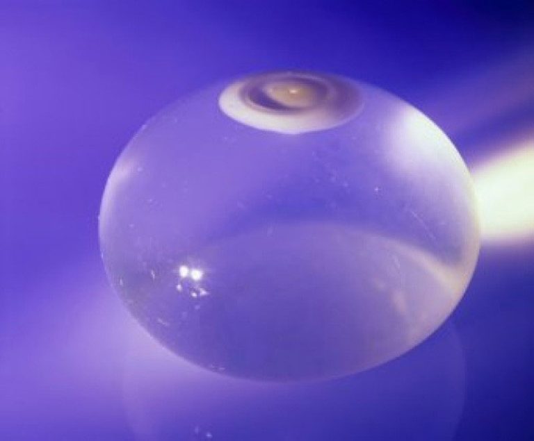 Ballon gastrique – Ballon Gastrique